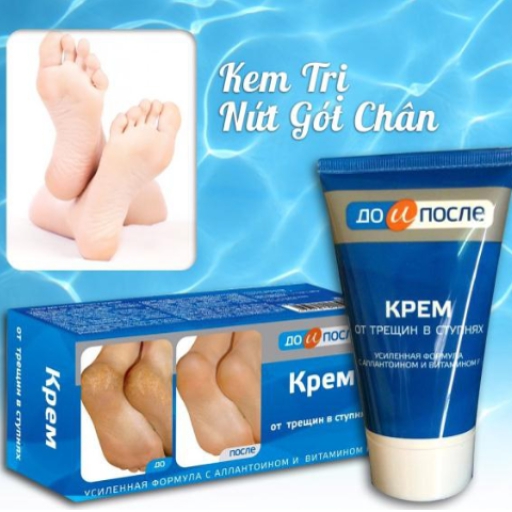 Kem Trị Nứt Gót Chân Kpem Nga - 50ml - Sbiz